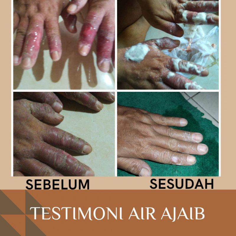 PENGOBATAN DIABETES BASAH